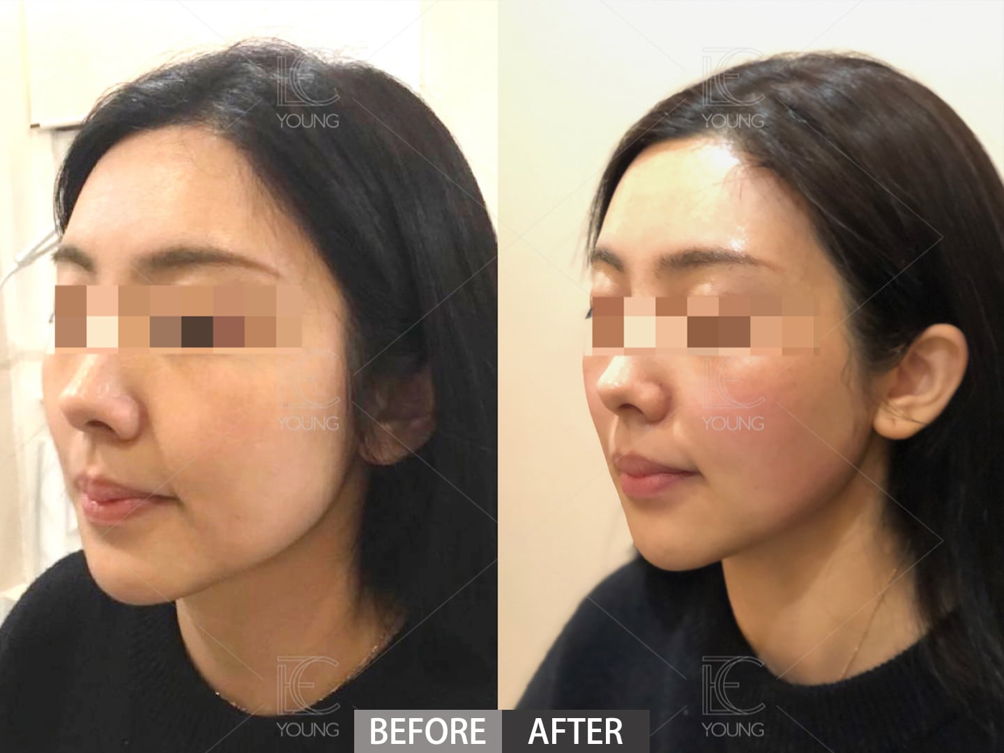 Thermage FLX - EC Aesthetic Clinic London