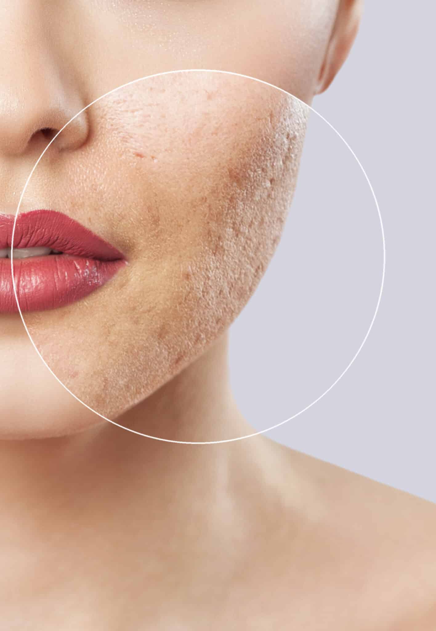 INTRAcel RF Microneedling - EC Aesthetic London