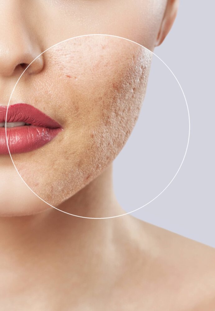 INTRAcel RF Microneedling - EC Aesthetic London